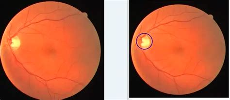 Github Ali John Optic Disc Extraction From Retinal Images