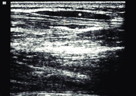 Tenosynovitis Of The Extensor Digitorum Tendon A Widened Tendon Download Scientific Diagram