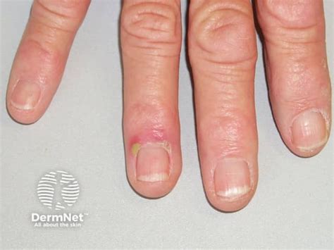 Finger Infection Around Nail