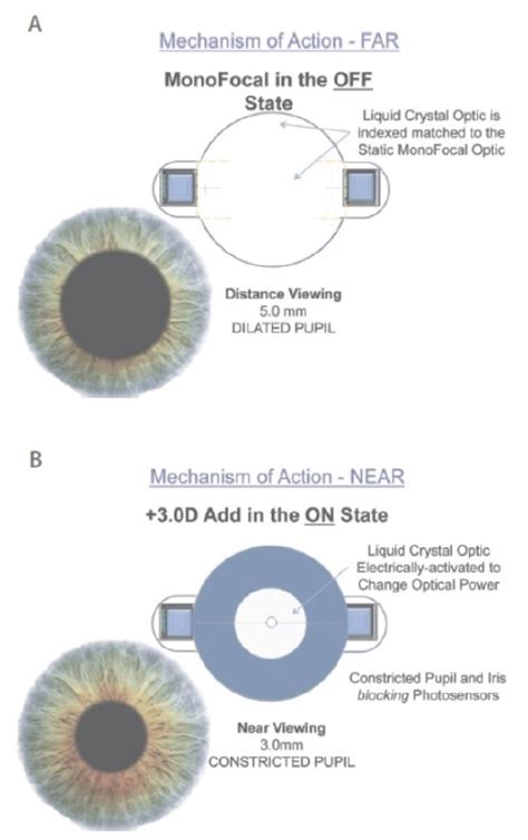 Refractive Surgery Overview Published In Cro Clinical And Refractive Optometry Journal