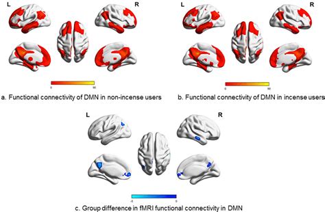 Results Of Fmri Seed Based Functional Connectivity In The Dmn