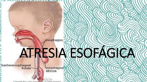 Atresia Esofágica Altamirano Najera Amayrany Udocz