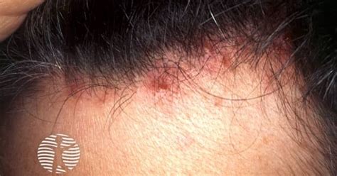 Scalp Folliculitis Image