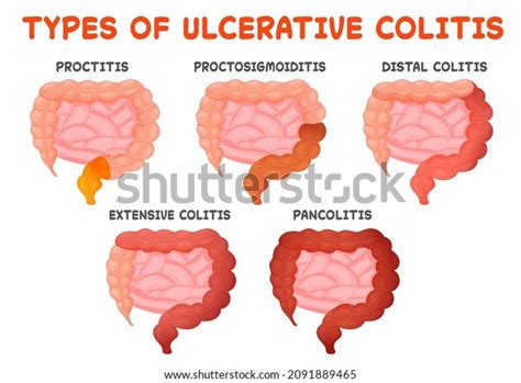 Proctitis Images Stock Photos D Objects Vectors Shutterstock