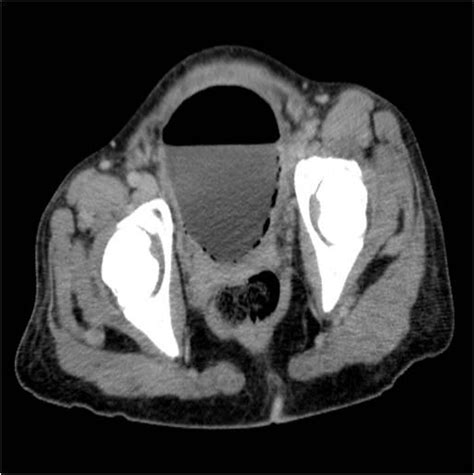 Acute Pyelonephritis With Emphysematous Cystitis Eurorad