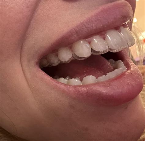 New Set Of Aligners Someone Help Lol Raligners