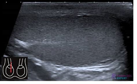 Echo Scrotum