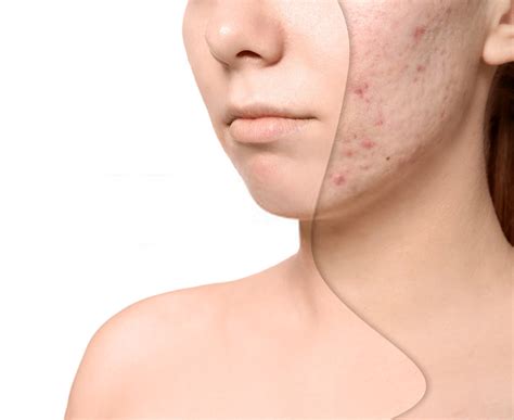 Secrets To Managing Acne Internally And Externally Melbourne Wellness