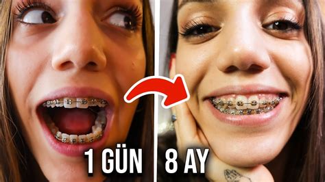 DİŞ TELLERİYLE 8 AY Tel Tedavimde 8 Ay Öncesi ve Sonrası Bu