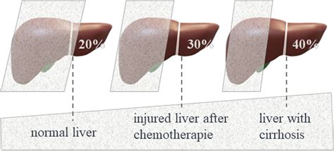 Recommended Volume Of The Future Liver Remnant Flr Before Liver Download Scientific Diagram