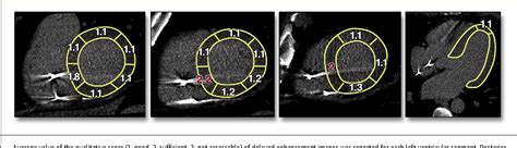 Figure 1 From Cardiac Ct With Delayed Enhancement In The