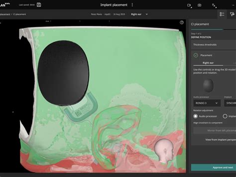 New Features In Otoplan Enhanced Hearing Implant Individualization Med El Professionals Blog
