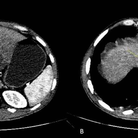 Case 1 Contrast Enhanced Ct Axial Showing A Compression Of The Download Scientific Diagram