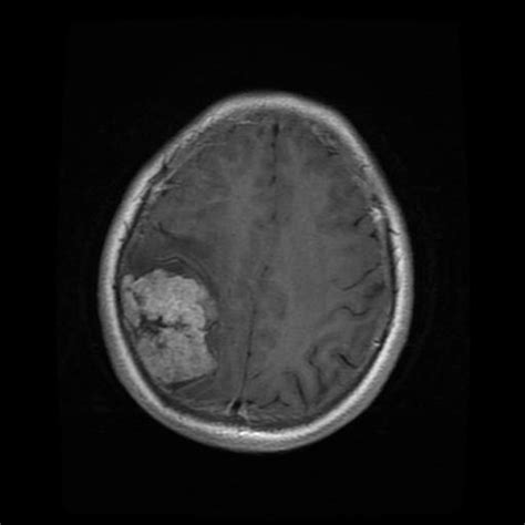 Brain Tumor Detection Object Detection Model By Deeplens