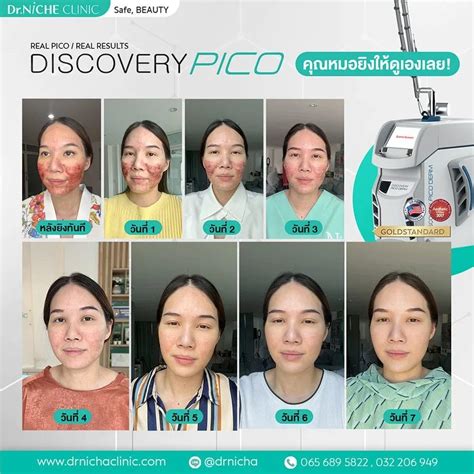 รีวิว 7 วัน หลังทำ Discovery Pico หลุมสิว พักหน้ากี่วัน