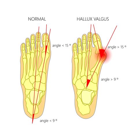 Hallux Valgus Interphalangeus Causes And Best Treatment