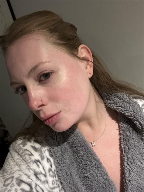 Diagnosed With Pd Looking For Product Recommendations R Perioral Dermatitis