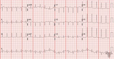 Lewis Lead Ecg Stampede
