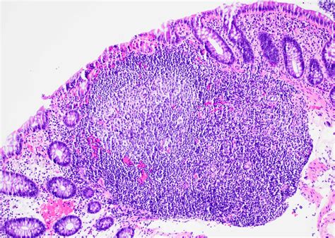 Hyperplastic Polyp Pathology Outlines Clinical Pathology Intestinal