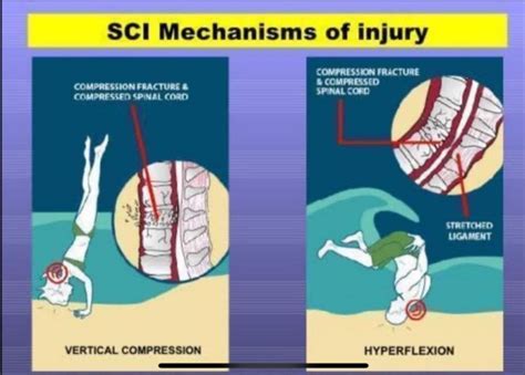 Гол нуурын усанд үсэрч шумбах нь хүзүү нурууны гэмтэл үүсгэх эрсдэлтэй