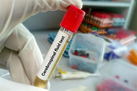 Pandys Test Procedure Interpretation And Clinical Significance