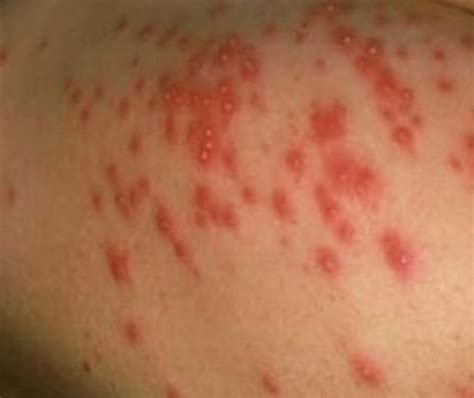 Pseudomonas Folliculitis A Bacterial Folliculitis That Can Not Be