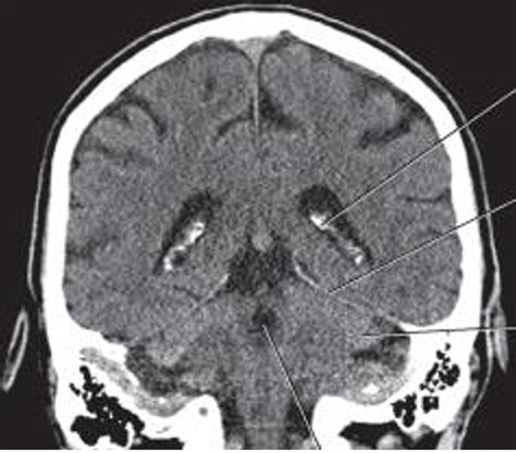 Coronal Ct Choroid Plexus Diagram Quizlet