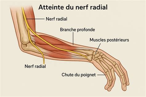 Atteinte Du Nerf Radial Perte De Mobilité Symptômes Et Soins