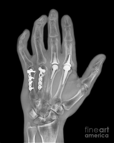 Knuckle Replacement X Ray By Science Photo Library