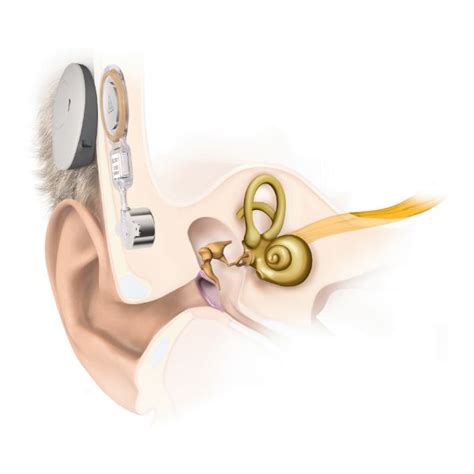 Different Between Bone Anchored Hearing Aid Baha And Cochlear Implants