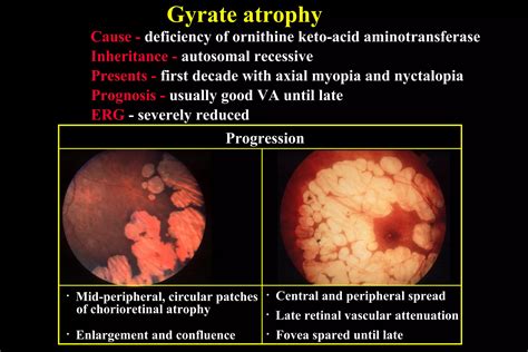 47 Hereditary Choroidal Dystropathies Ppt