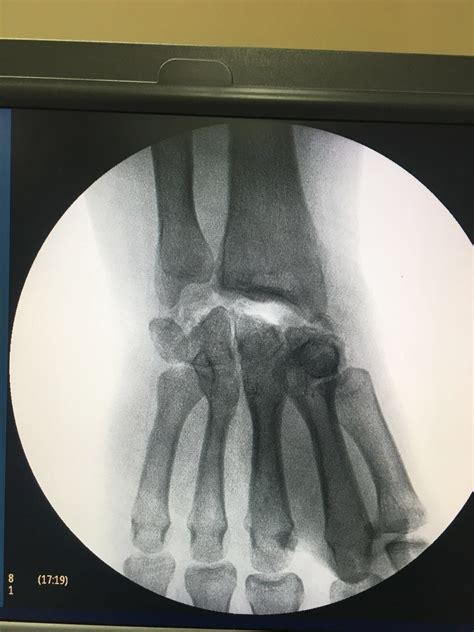 Proximal Row Carpectomy