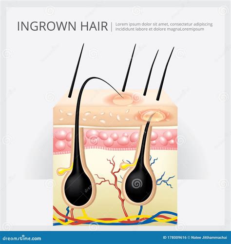 Ingrown Hair Structure Cartoon Vector 114067163