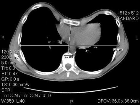 Haller Index Alchetron The Free Social Encyclopedia