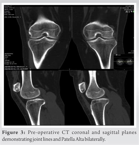 Patellofemoral Arthroplasty For Irreducible Chronic Bilateral Patella Dislocation A Case Report