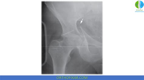 Acetabulum Fracture Full Explained Orthofixar 2025