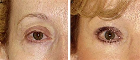 Periorbital Fat Grafting Facial Plastic Surgery Clinics