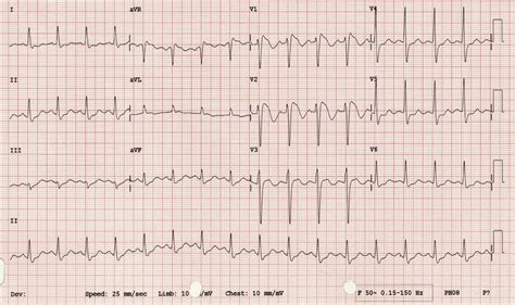 Medical Concept Ecgs In Syncope Canadiem