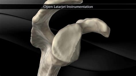 Arthrex Open Latarjet Instrumentation