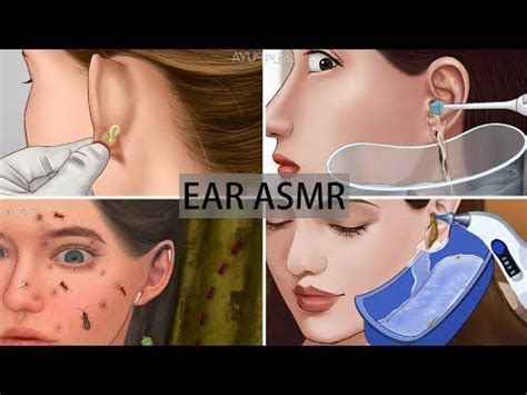 Asmr Remove Ear Piercing Pus Ear Pimple Blackhead Care Sebaceous Cyst Removal Ear Cleaning Y