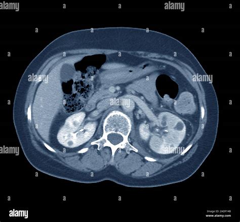 Pyelonephritis Axial Computed Tomography Ct Scan Through The Abdomen Of A 54 Year Old Woman
