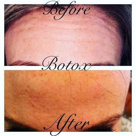 Botox Dosing Information Facial Injections Info Prices Photos Reviews Qanda