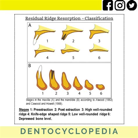 Dentocyclopedia Residual Ridge Resorption Follow Us 👉