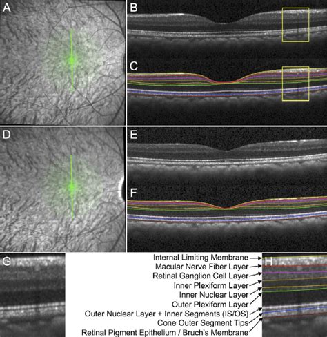 Spectral Domain OCT B Scan Image Segmentation To Measure Macular Layer Download Scientific
