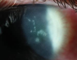 Dendritic Corneal Ulcer
