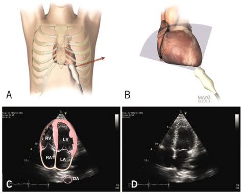 Ultrasound Probe Orientation Breast Ultrasound Probe Positioning