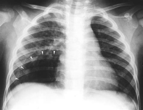 Bronchopulmonary Sequestration Vats Surgical Anatomical Resection Of