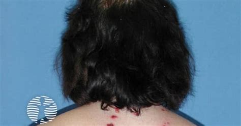 Pemphigus Vulgaris Image