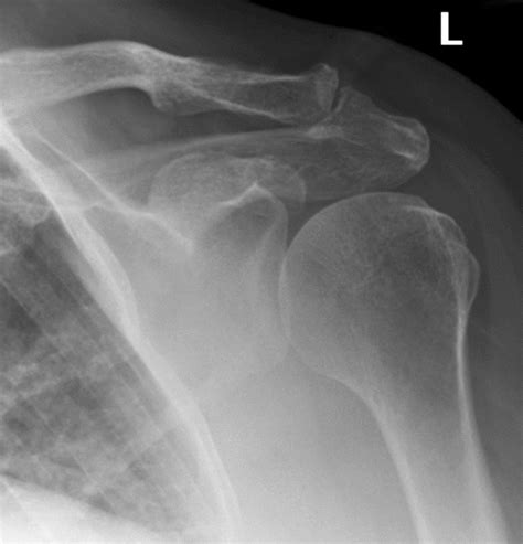Arthrosis Of Acromioclavicular Joint Image To U