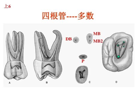 盘点磨牙开髓的方法 好医术文章 好医术 赋能医生守护生命